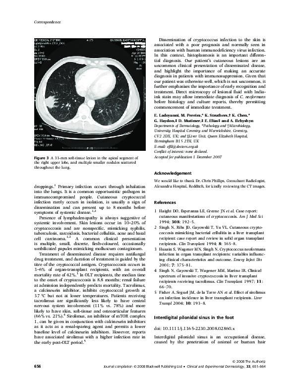 (PDF) Interdigital pilonidal sinus in the foot | MARIA ISABEL RODRIGUEZ ...