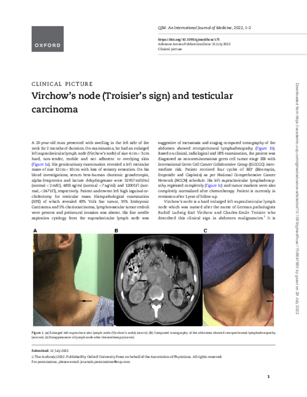 (PDF) Virchow’s node (Troisier’s sign) and testicular carcinoma