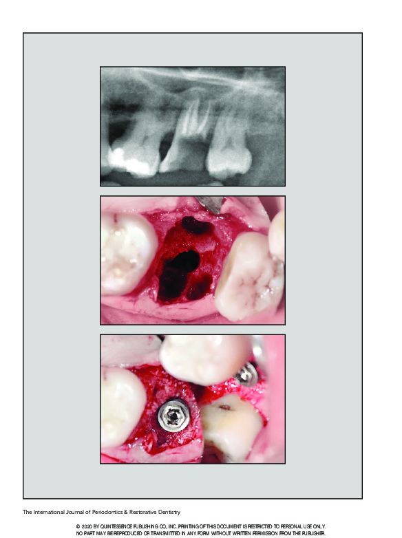 (PDF) A Retrospective Study of Bone Level Stability Around 441 Mandibular and 350 Maxillary ...