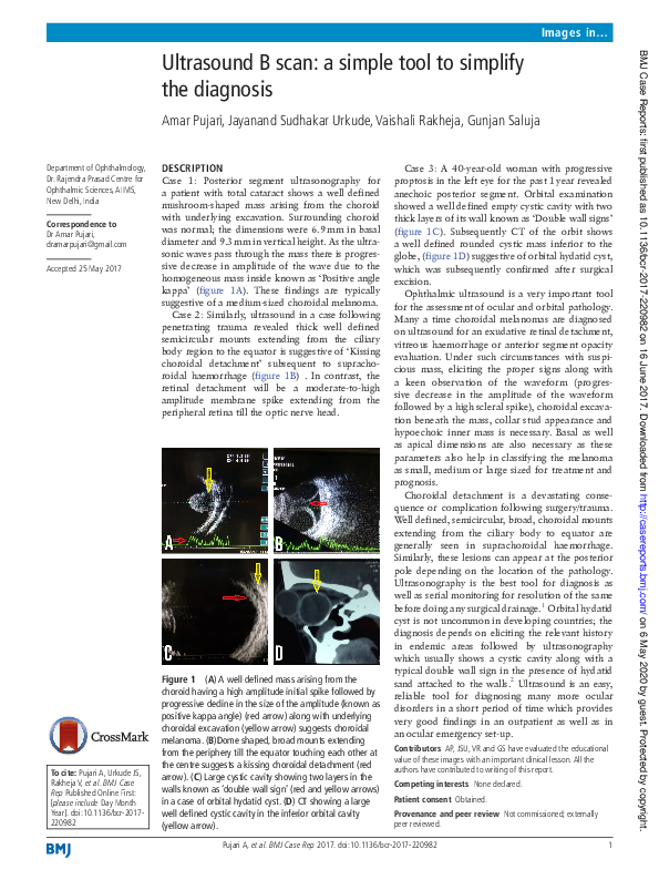 (PDF) Ultrasound B scan: a simple tool to simplify the diagnosis