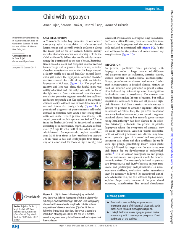 (PDF) Child with hypopyon