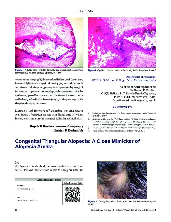 (PDF) Congenital triangular alopecia: A close mimicker of alopecia areata