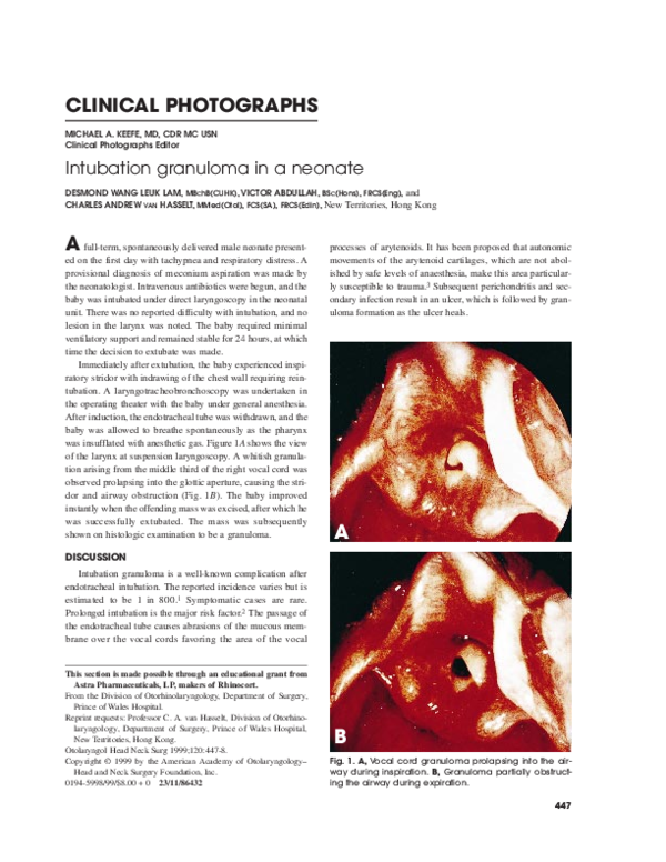 (PDF) Intubation granuloma in a neonate