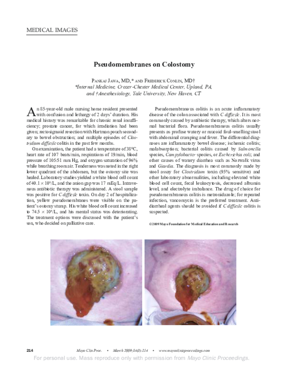 (PDF) Pseudomembranes on Colostomy