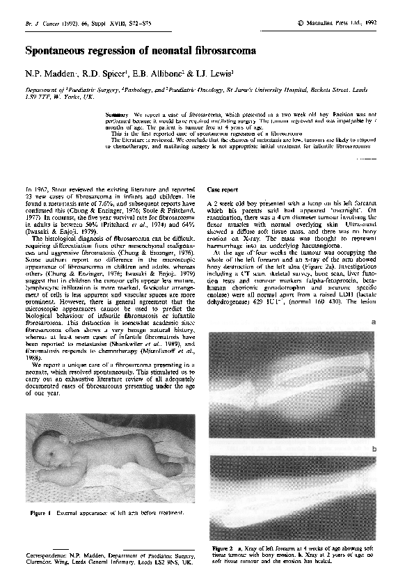 (PDF) Spontaneous regression of neonatal fibrosarcoma