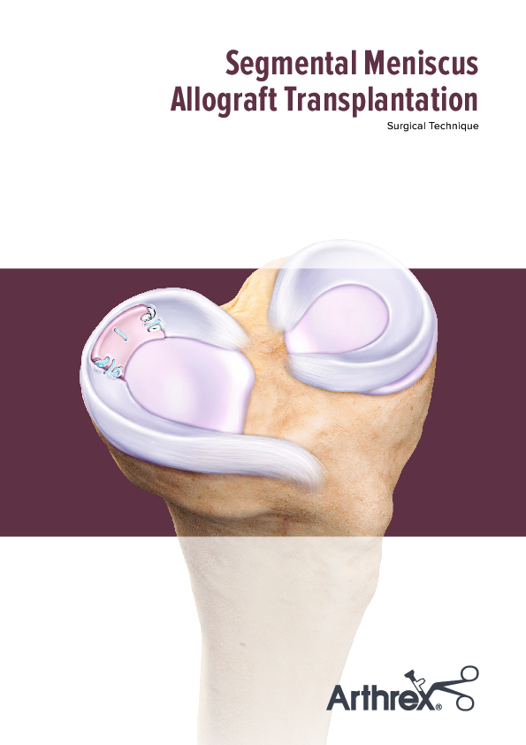 (PDF) Segmental Meniscus Allograft Transplantation | Annalise Peebles ...