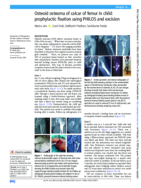 (PDF) Osteoid osteoma of calcar of femur in child: prophylactic ...