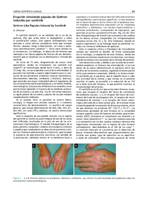 (PDF) Erupción simulando pápulas de Gottron inducida por sunitinib