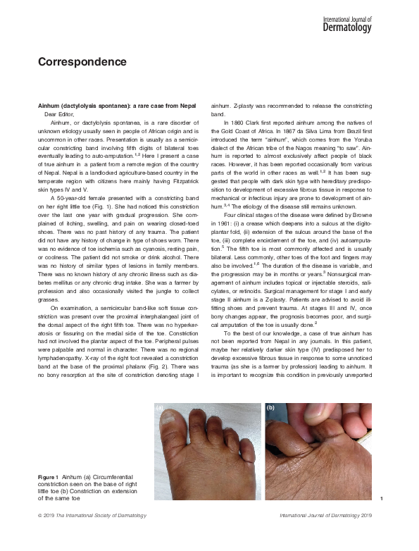 (PDF) Ainhum (dactylolysis spontanea): a rare case from Nepal