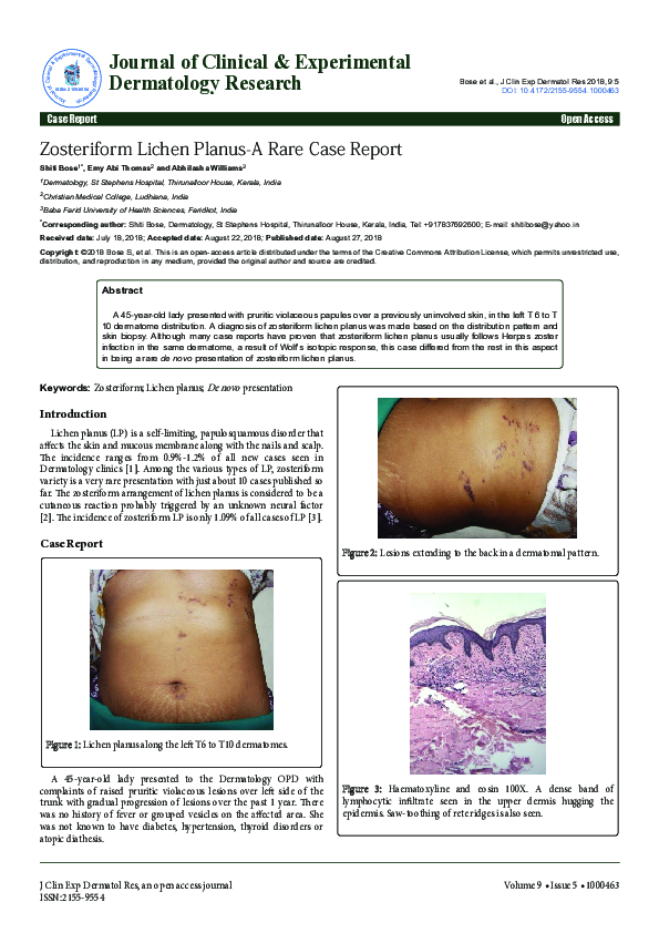 (PDF) Zosteriform Lichen Planus-A Rare Case Report | Shiti Bose ...
