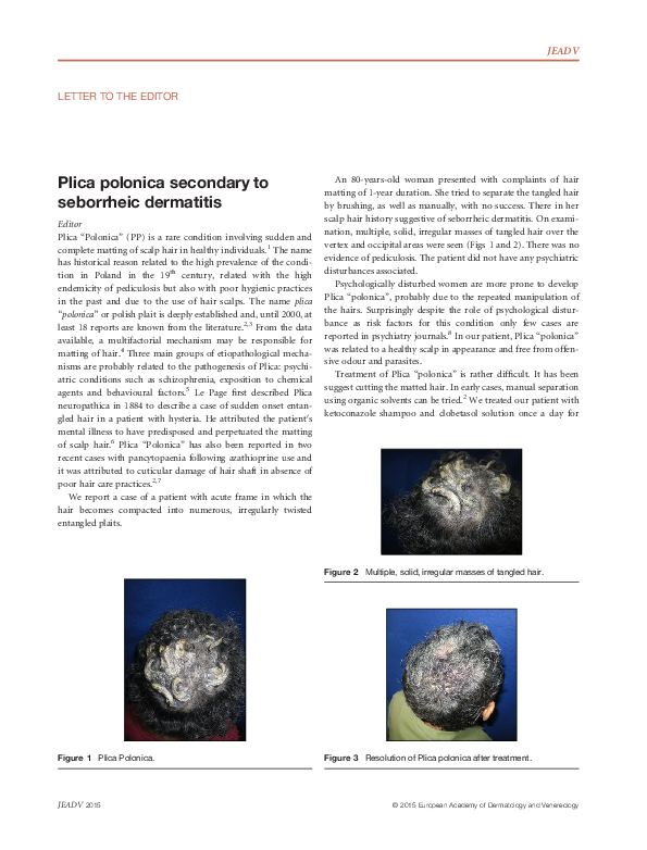 (PDF) Plica polonica secondary to seborrheic dermatitis | Juliana ...