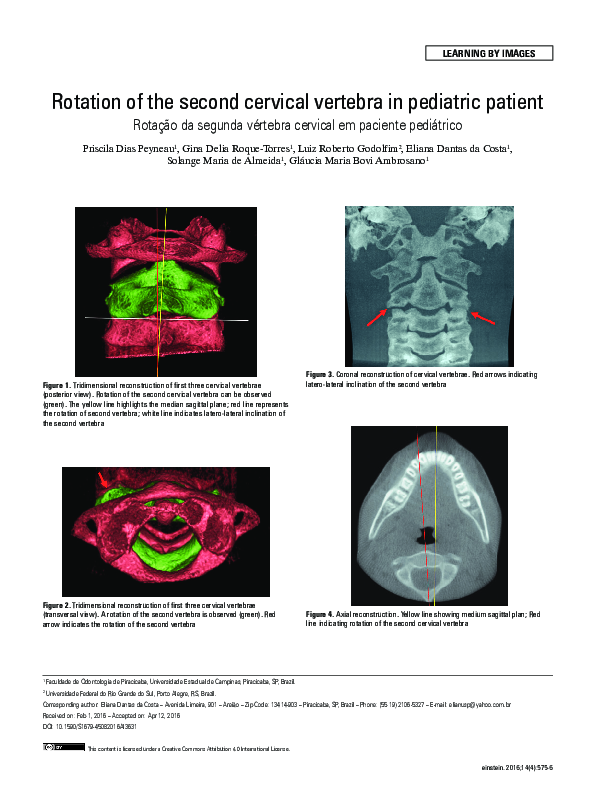 (PDF) Rotation of the second cervical vertebra in pediatric patient ...