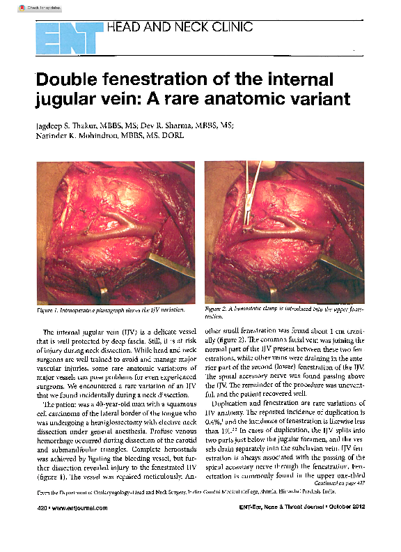 (PDF) Double Fenestration of the Internal Jugular Vein: A Rare Anatomic ...