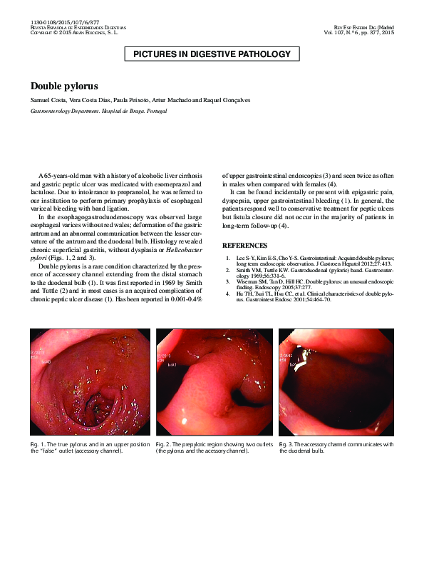 (PDF) Double pylorus