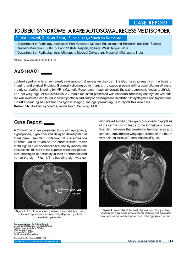 (PDF) Joubert Syndrome-A Rare Autosomal Recessive Disorder