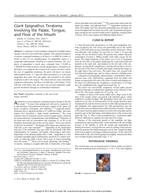 (PDF) Giant Epignathus Teratoma Involving the Palate, Tongue, and Floor ...