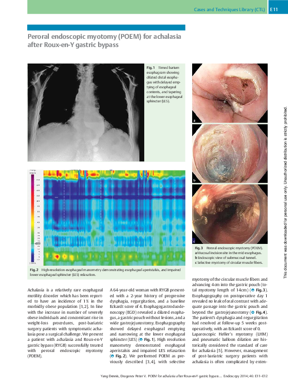 (PDF) Peroral endoscopic myotomy (POEM) for achalasia after Roux-en-Y ...