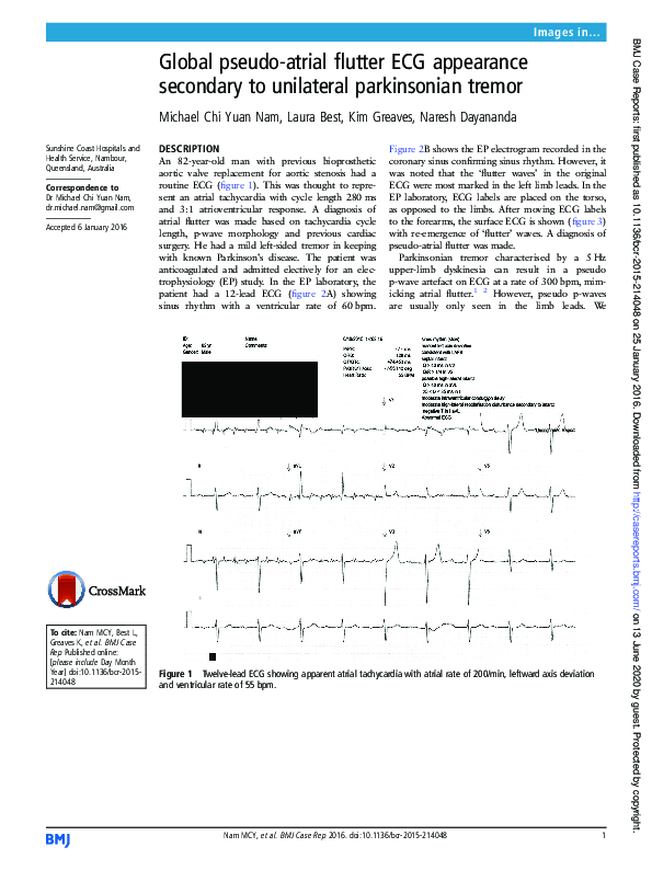 (PDF) Global pseudo-atrial flutter ECG appearance secondary to ...