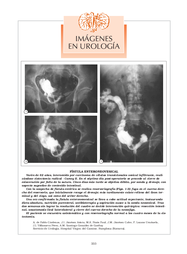 (PDF) Fístula enteroneovesical