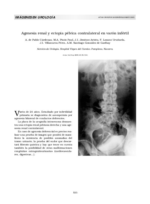 (PDF) Agenesia renal y ectopia pélvica contralateral en varón infértil
