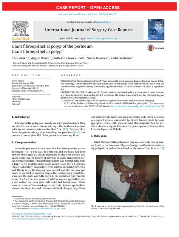 (PDF) Giant fibroepithelial polyp of the perineum