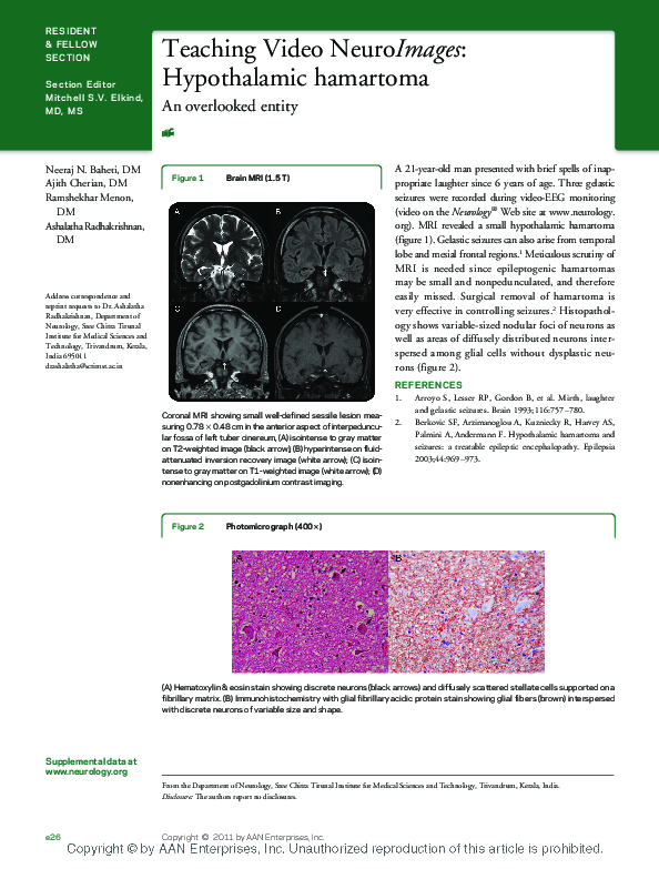(PDF) Teaching Video NeuroImages: Hypothalamic hamartoma: An overlooked entity