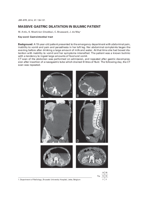 (PDF) Massive gastric dilatation in bulimic patient