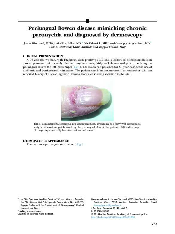 (PDF) Periungual Bowen disease mimicking chronic paronychia and ...