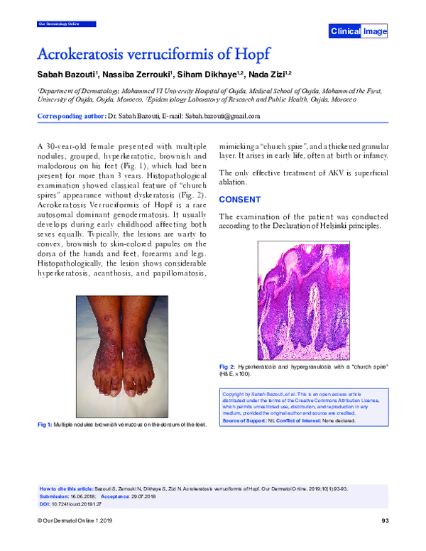 (PDF) Acrokeratosis verruciformis of Hopf