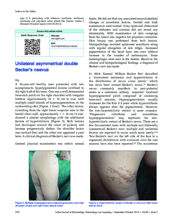 (PDF) Unilateral asymmetrical double Becker′s naevus | Naresh Rai ...