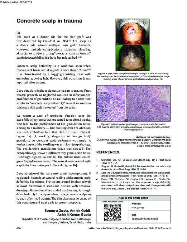 (PDF) Concrete scalp in trauma