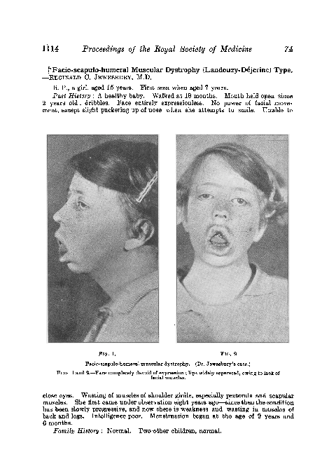 (PDF) Facioscapulohumeral muscular dystrophy (Landouzy-Dejerine type ...