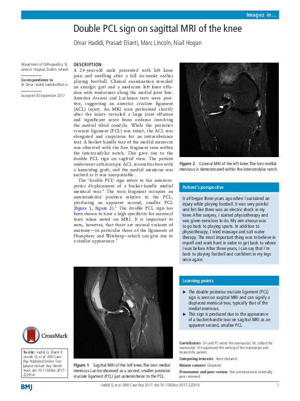 (PDF) Double PCL sign on sagittal MRI of the knee | Prasad Ellanti ...