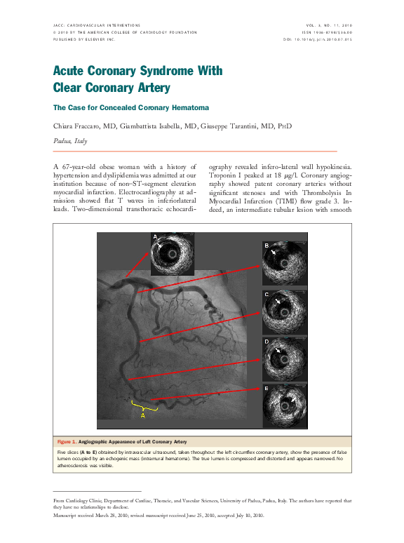 (PDF) Acute Coronary Syndrome With Clear Coronary Artery