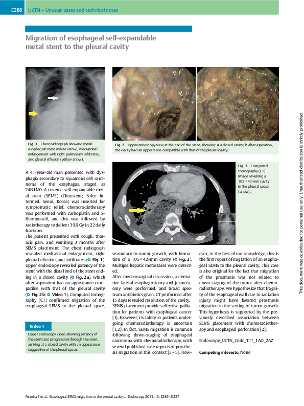 (PDF) Migration of esophageal self-expandable metal stent to the ...