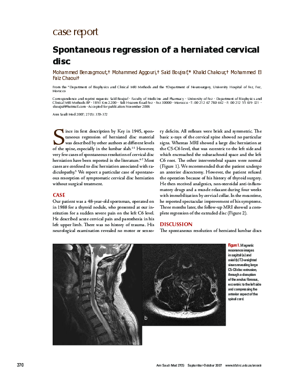 (PDF) Spontaneous regression of a herniated cervical disc