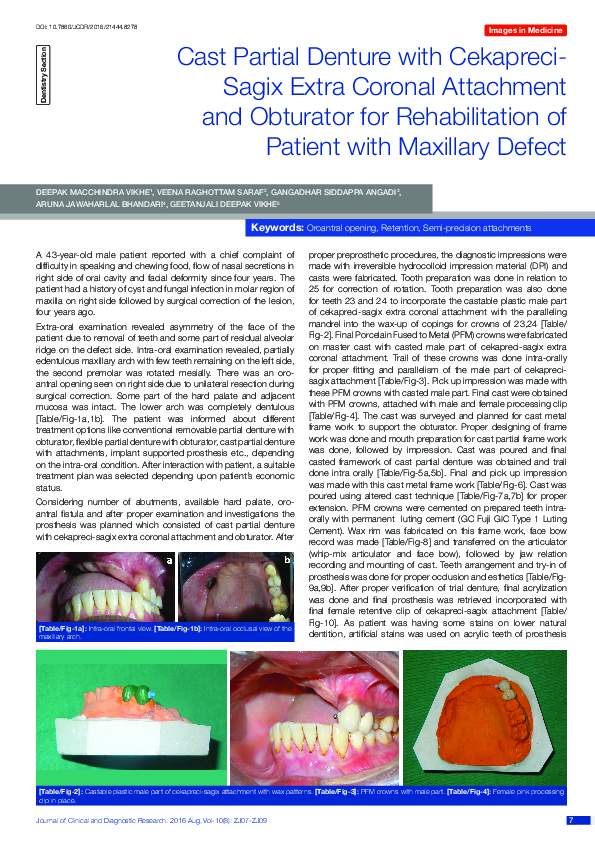(PDF) Cast Partial Denture with Cekapreci- Sagix Extra Coronal ...