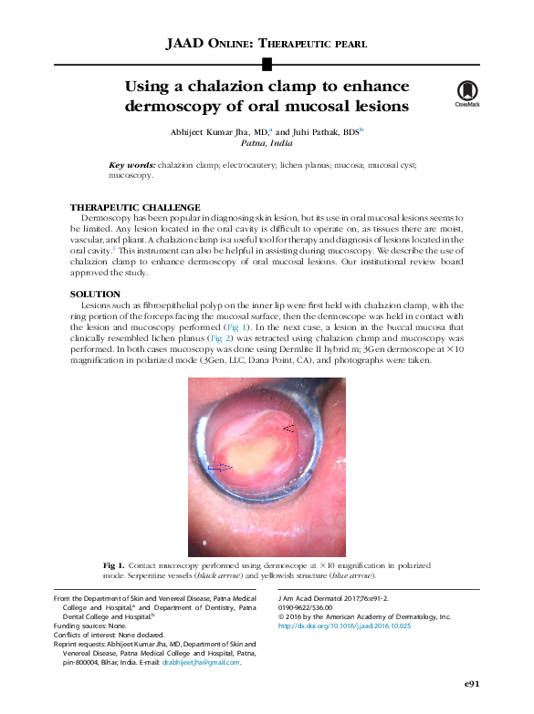 (PDF) Using a chalazion clamp to enhance dermoscopy of oral mucosal lesions