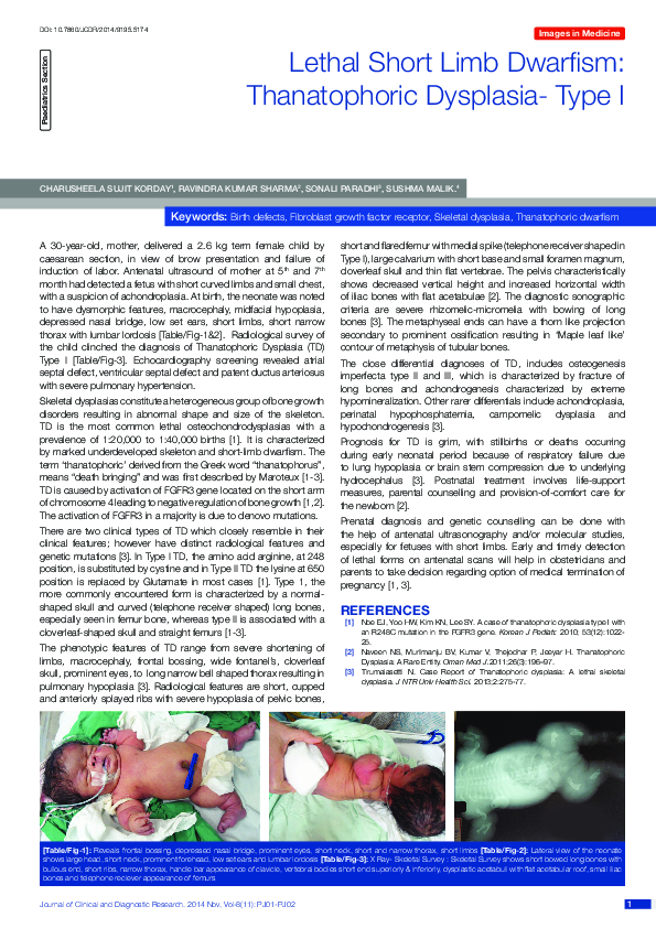 (PDF) Lethal Short Limb Dwarfism: Thanatophoric Dysplasia- Type I