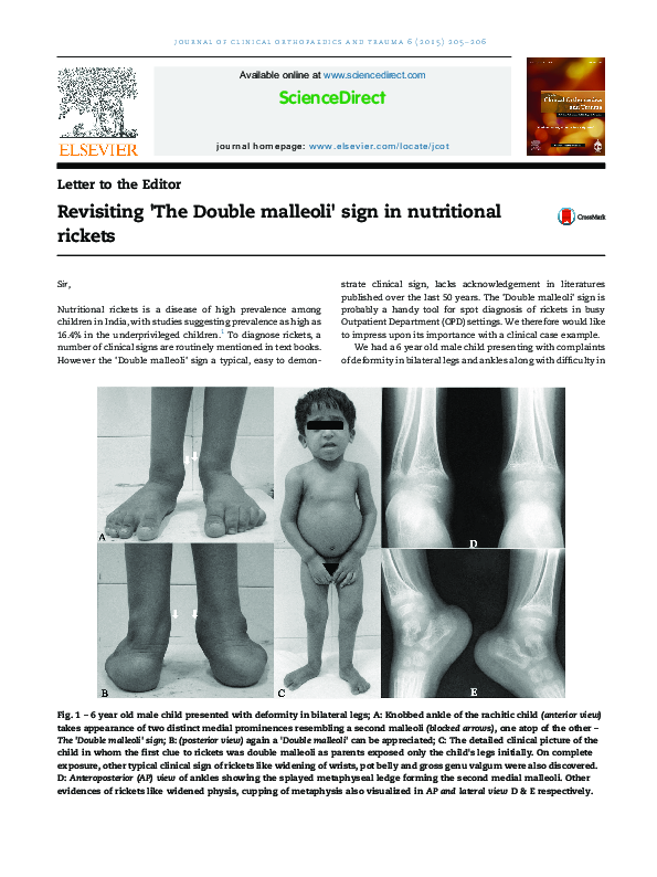 (PDF) Revisiting ‘The Double malleoli’ sign in nutritional rickets
