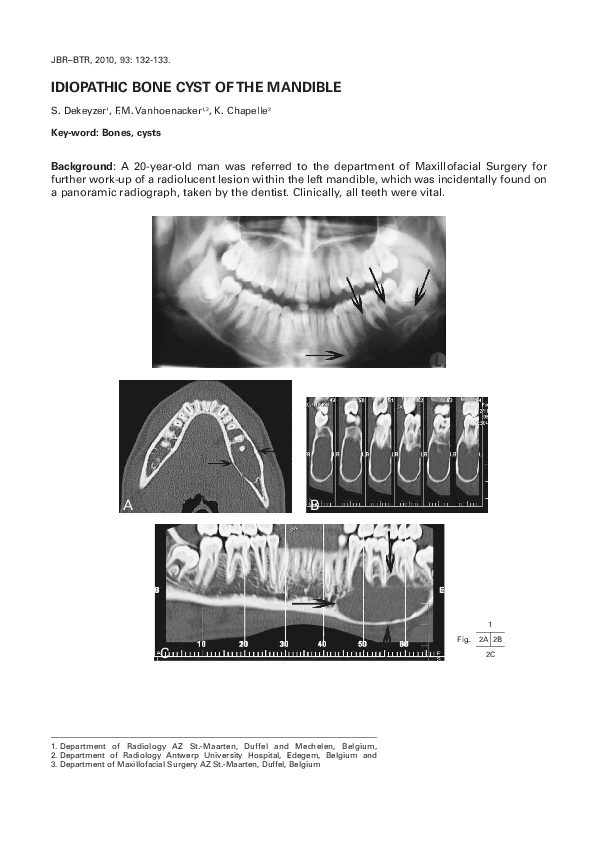 (PDF) Idiopathic bone cyst of the mandible