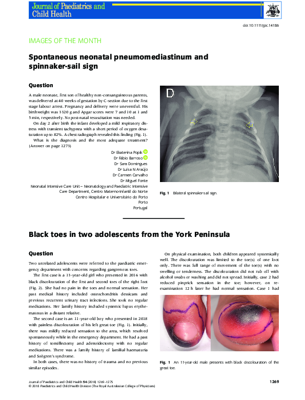 (PDF) Spontaneous neonatal pneumomediastinum and spinnaker-sail sign ...