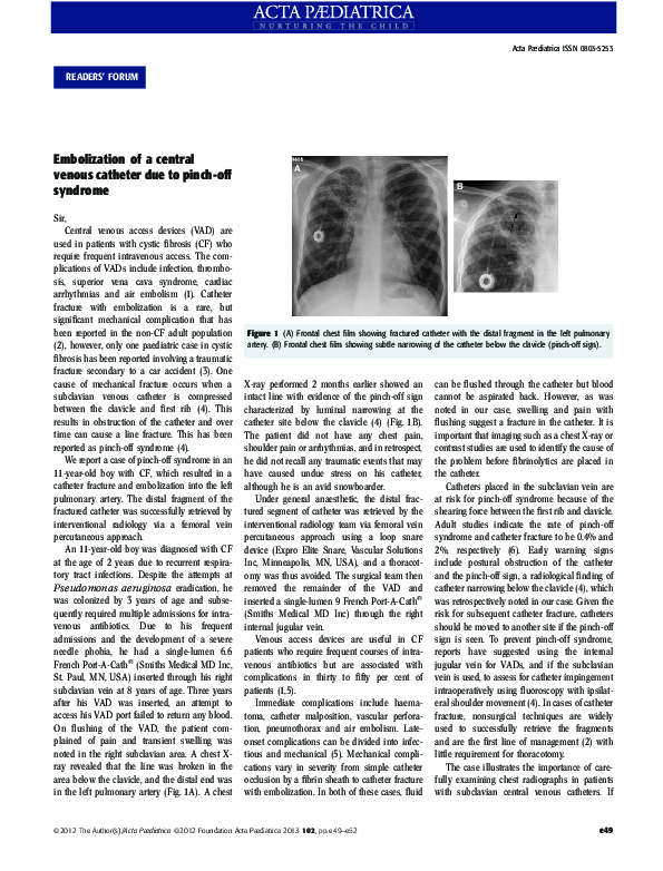 (PDF) Embolization of a central venous catheter due to pinch-off ...
