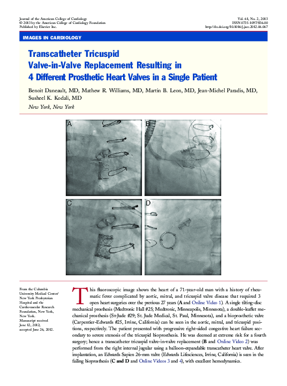 (PDF) Transcatheter Tricuspid Valve-in-Valve Replacement Resulting in 4 ...