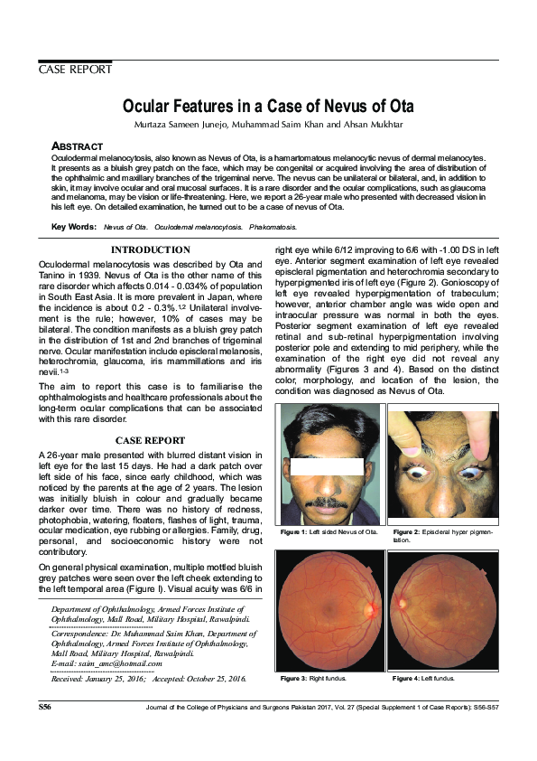 (PDF) Ocular Features in a Case of Nevus of Ota
