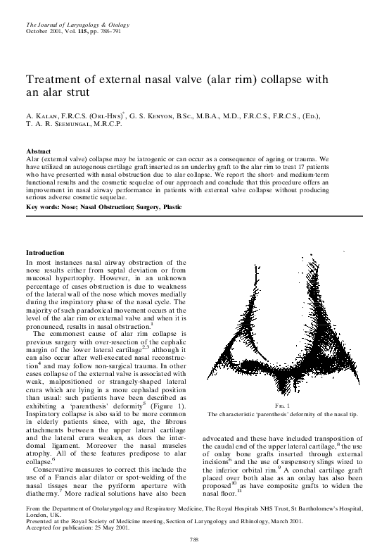 (PDF) Treatment of external nasal valve (alar rim) collapse with an ...