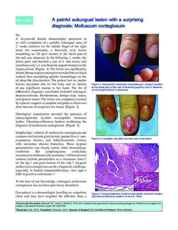 (PDF) A painful subungual lesion with a surprising diagnosis: Molluscum ...