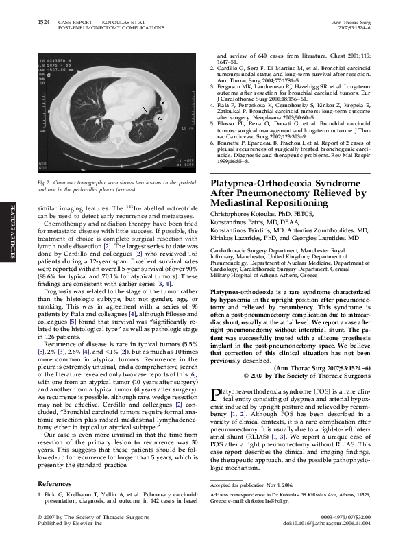 (PDF) Platypnea-Orthodeoxia Syndrome After Pneumonectomy Relieved by ...