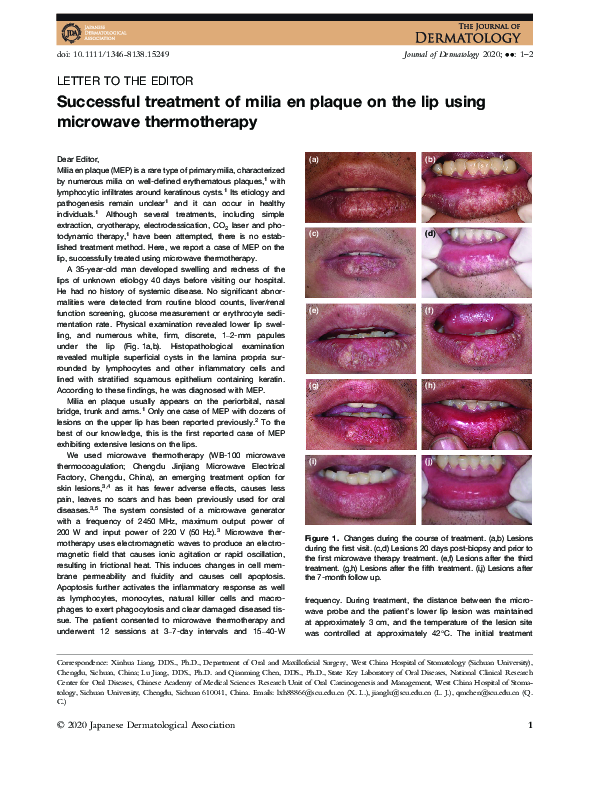 (PDF) Successful treatment of milia en plaque on the lip using ...