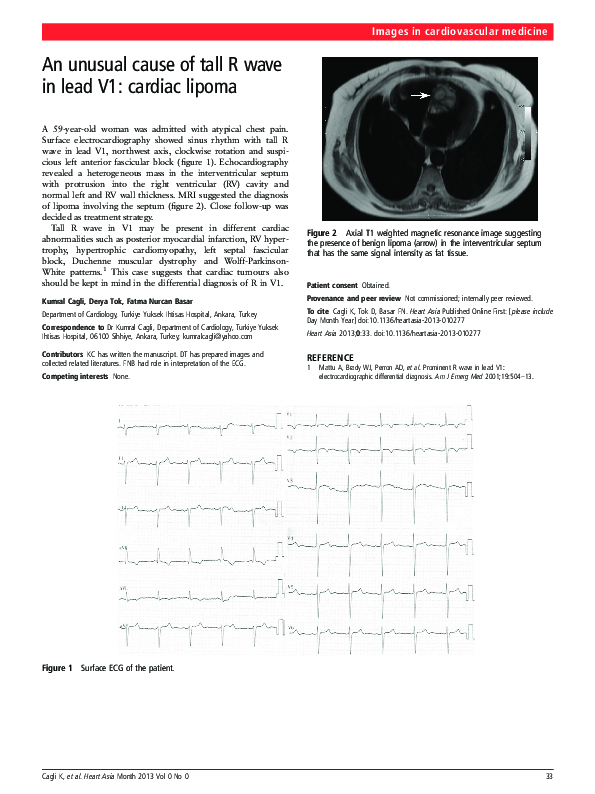 (PDF) An unusual cause of tall R wave in lead V1: cardiac lipoma